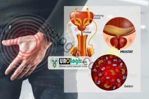 Prostatitis: Infeksi/Peradangan pada prostat - urologis.com