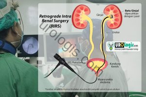 Retrograde Intra Renal Surgery (RIRS): Operasi Batu Ginjal Tanpa ...